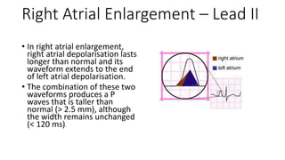 ECG basics simplified for students .pptx