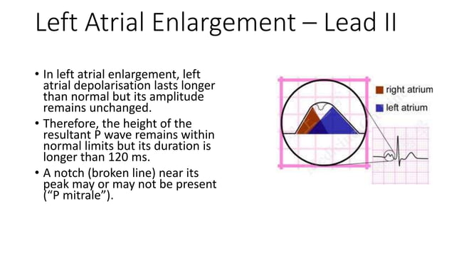 ECG basics simplified for students .pptx
