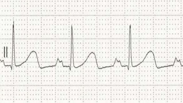 ECG basics simplified for students .pptx