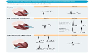 ECG basics simplified for students .pptx