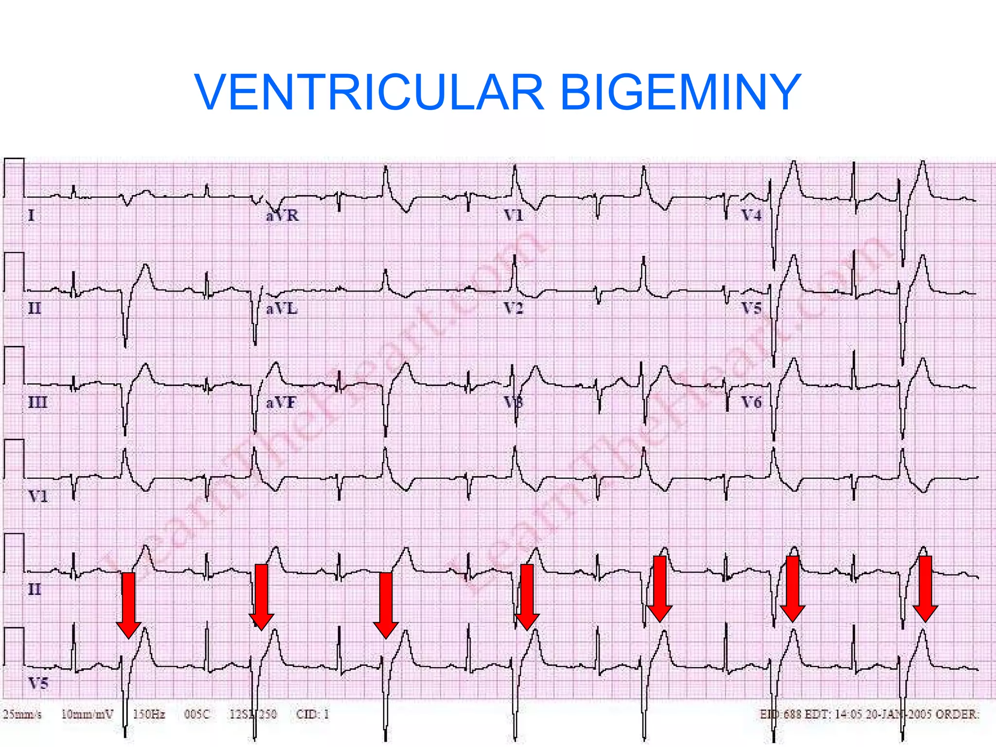 ECG: Ventricular Premature Beats | PPT