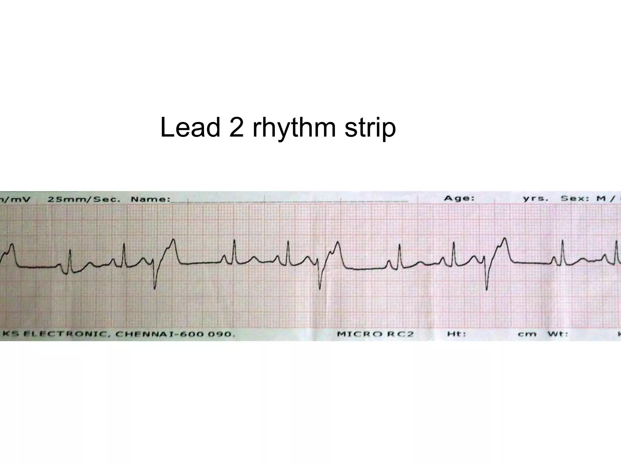 ECG: Ventricular Premature Beats | PPT