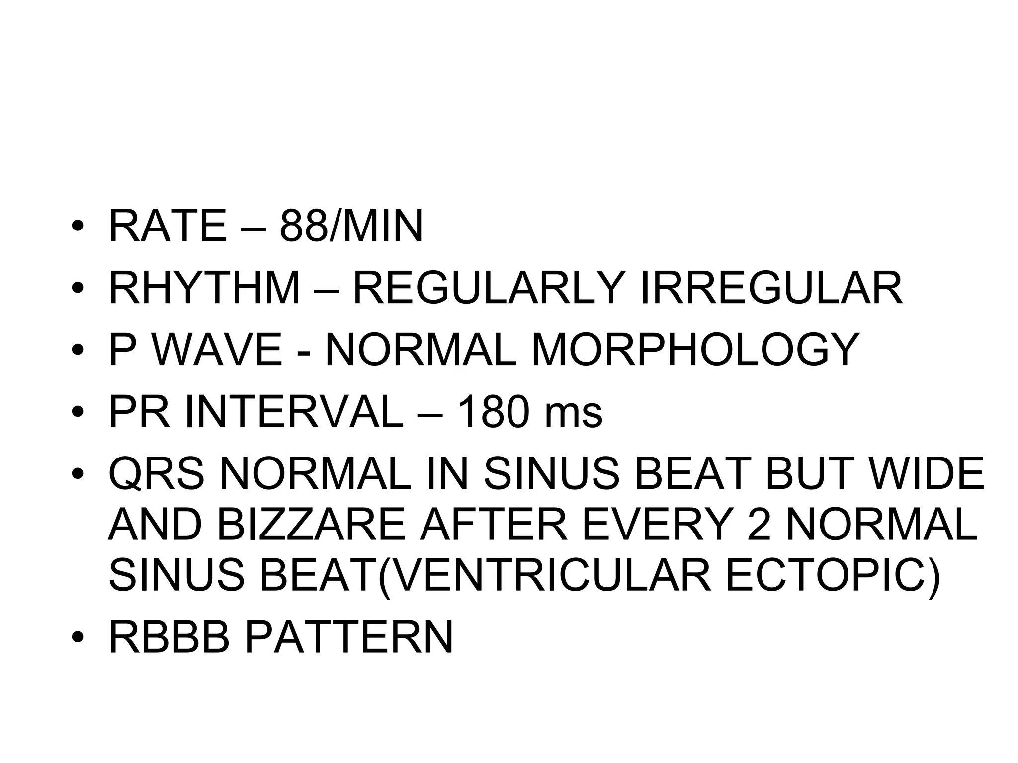 ECG: Ventricular Premature Beats | PPT