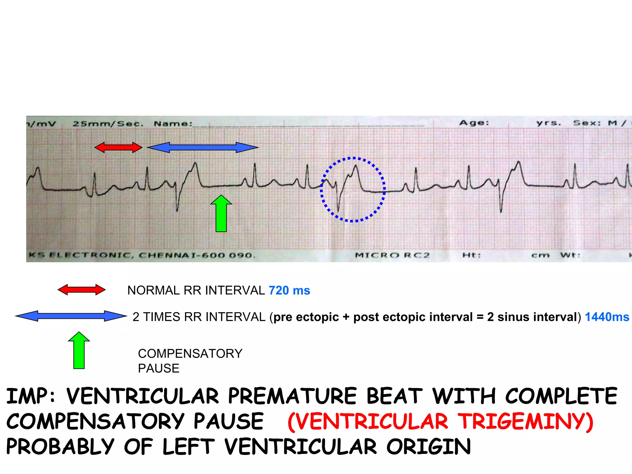 ECG: Ventricular Premature Beats | PPT