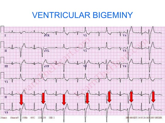 ECG: Ventricular Premature Beats | PPT | Heart and Cardiovascular ...