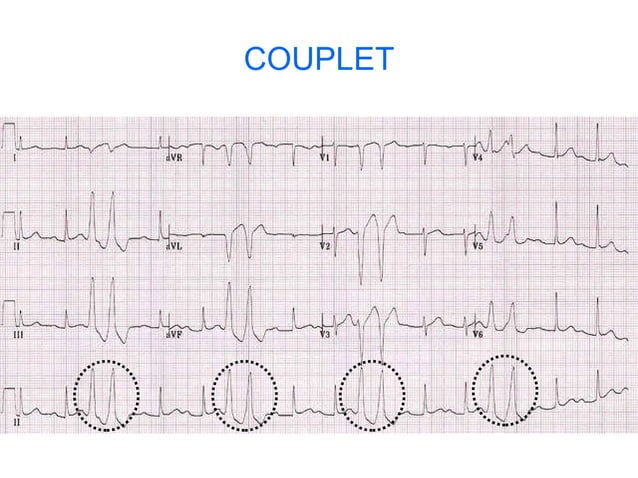 ECG: Ventricular Premature Beats | PPT | Heart and Cardiovascular ...