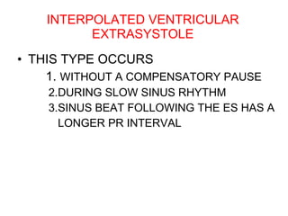 ECG: Ventricular Premature Beats | PPT