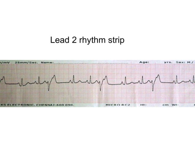 ECG: Ventricular Premature Beats | PPT | Heart and Cardiovascular ...