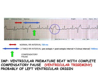 ECG: Ventricular Premature Beats | PPT
