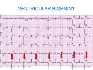 Ventricular Bigeminy