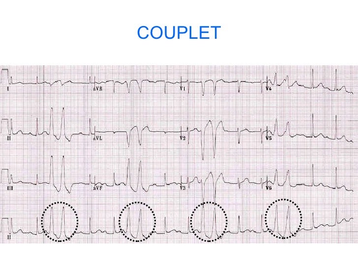 ECG: Ventricular Premature Beats