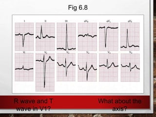 ECG3.ppt