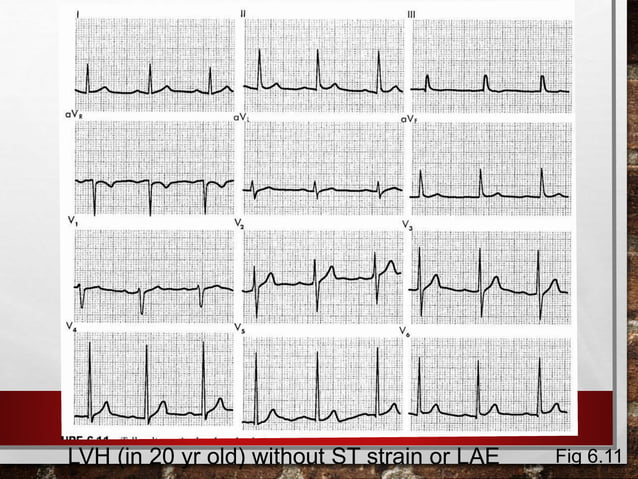 ECG3.ppt