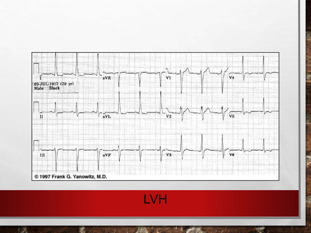 ECG3.ppt