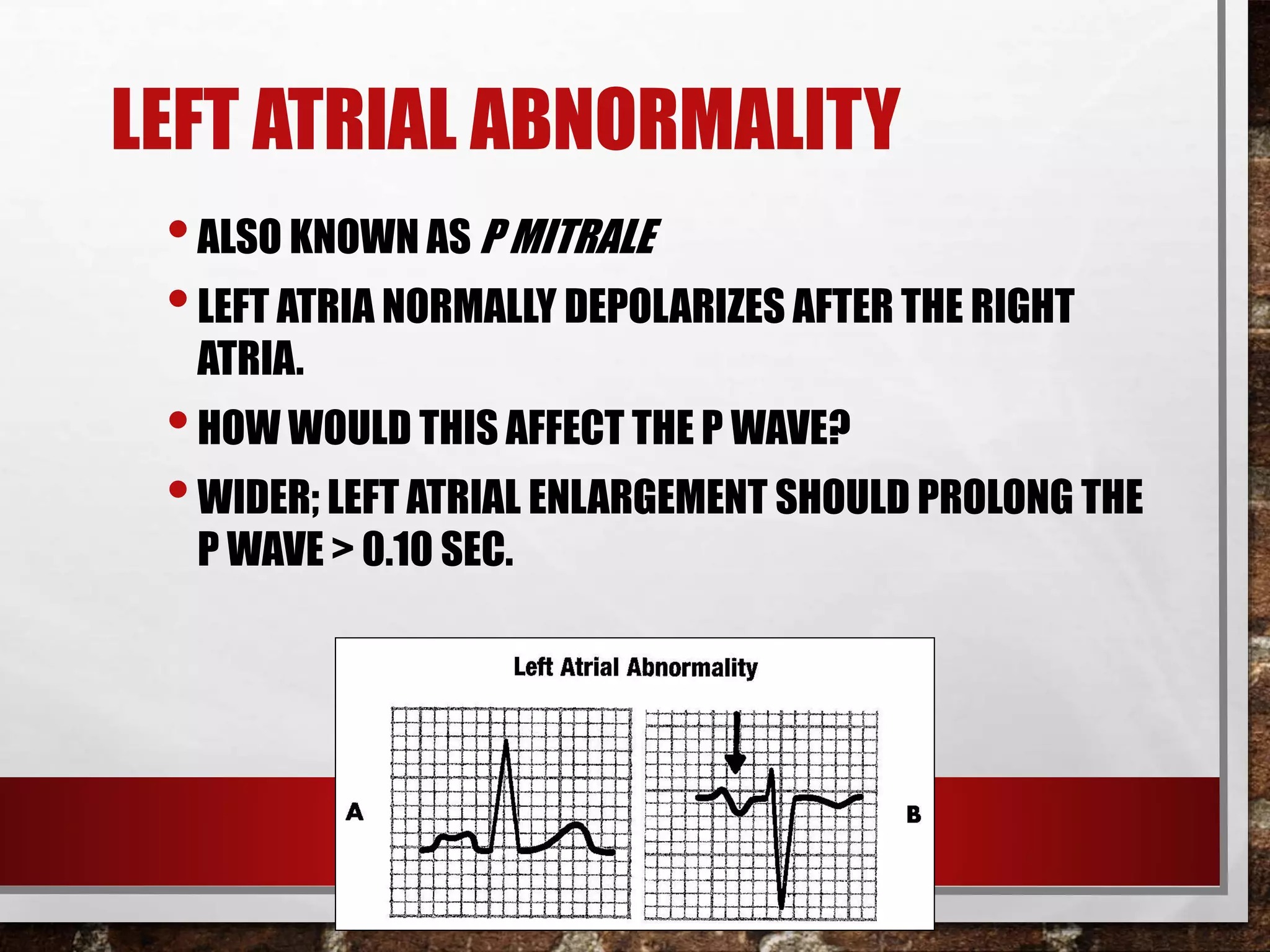 ECG3.ppt