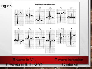 ECG3.ppt