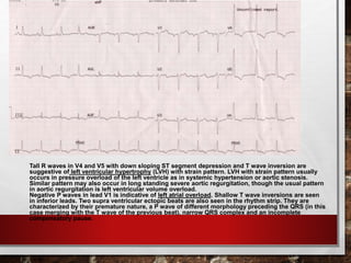 ECG3.ppt