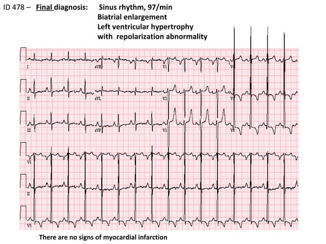 ECG#8 - ID478 - LVH BAE | PPT