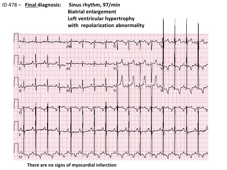 ECG#8 - ID478 - LVH BAE