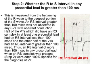 ECG: Fascicular VT | PPT