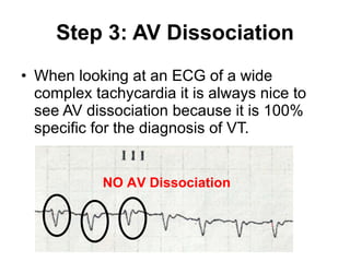 ECG: Fascicular VT | PPT
