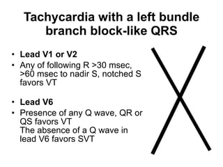 ECG: Fascicular VT | PPT