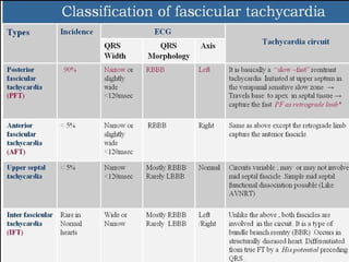 ECG: Fascicular VT | PPT