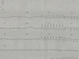 ECG: Fascicular VT | PPT