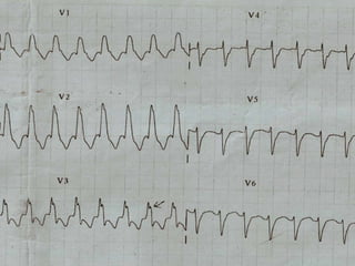 ECG: Fascicular VT | PPT
