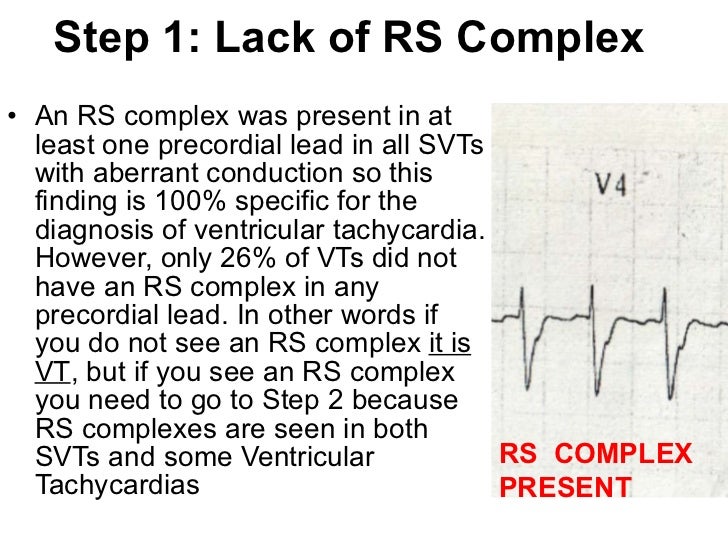 ECG: Fascicular VT