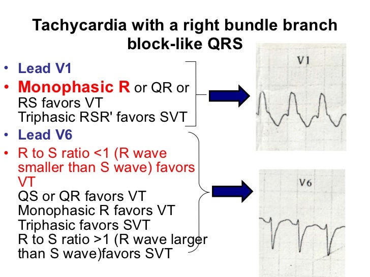 ECG: Fascicular VT