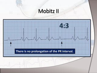 ECG A: AV blocks | PPSX | Heart and Cardiovascular Diseases | Diseases ...