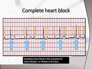 ECG A: AV blocks | PPSX | Heart and Cardiovascular Diseases | Diseases ...