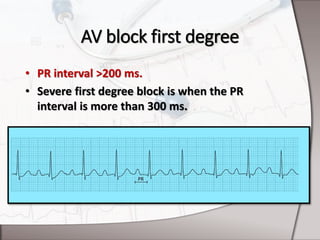 ECG A: AV blocks | PPSX | Heart and Cardiovascular Diseases | Diseases ...