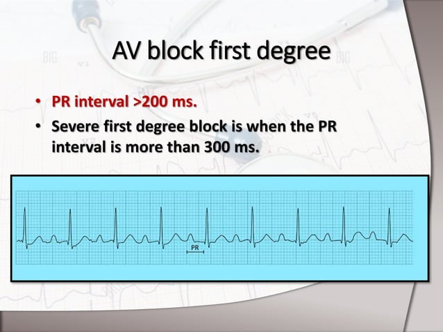 ECG A: AV blocks | PPSX | Heart and Cardiovascular Diseases | Diseases ...