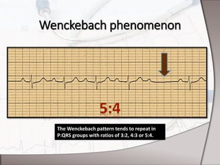 ECG A: AV blocks | PPSX | Heart and Cardiovascular Diseases | Diseases ...