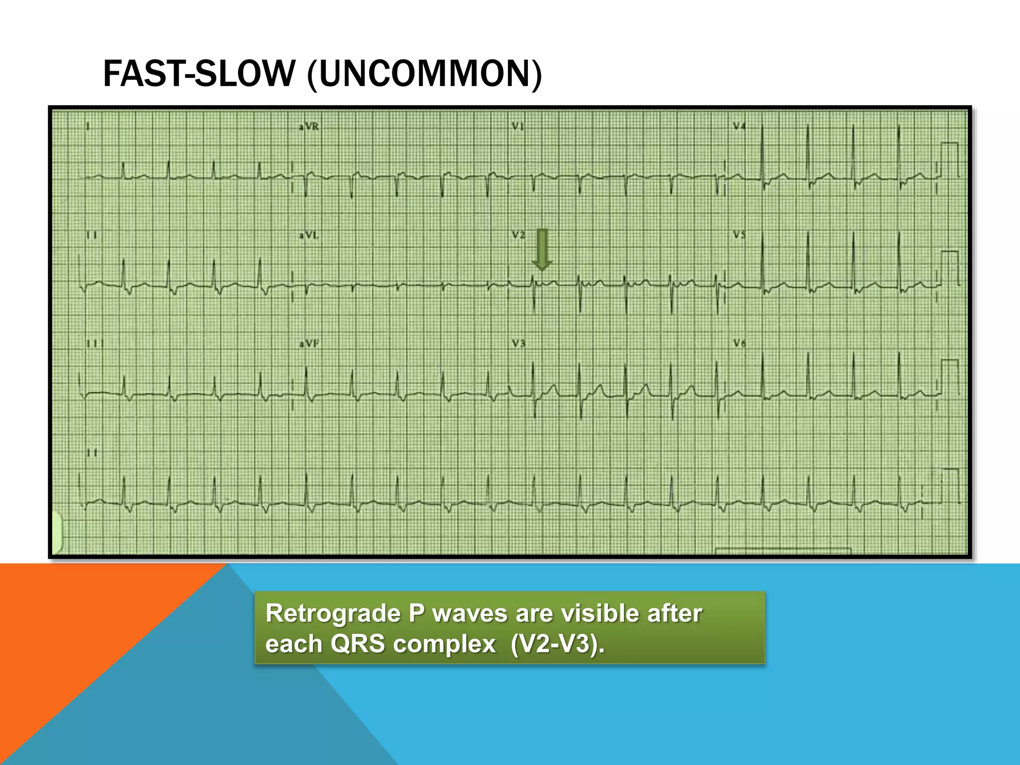 ECG A: AVNRT, AVRT | PPSX