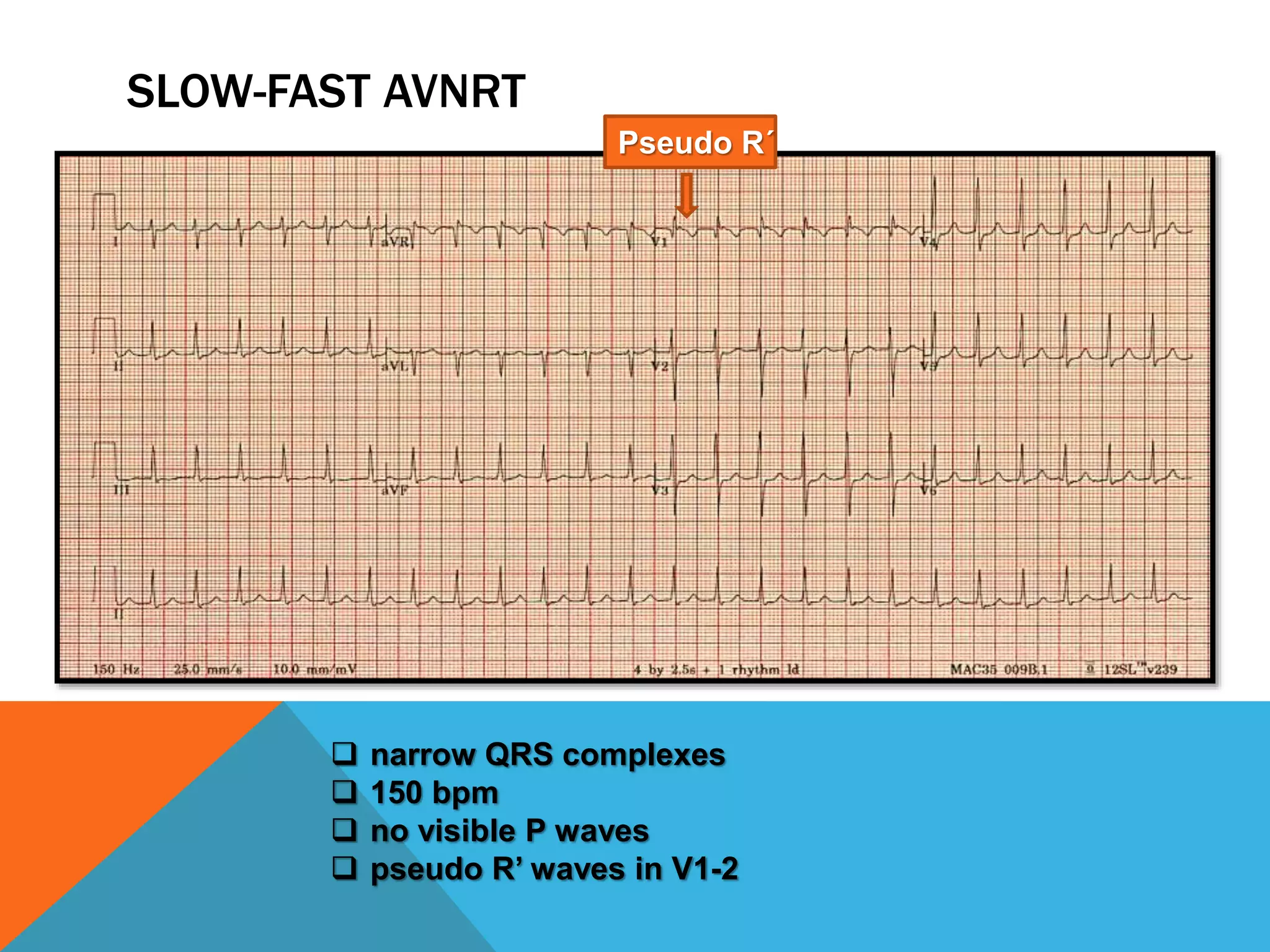 ECG A: AVNRT, AVRT | PPSX