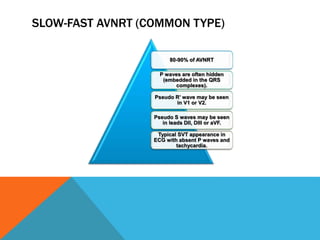 ECG A: AVNRT, AVRT | PPSX