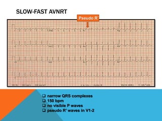 ECG A: AVNRT, AVRT | PPSX