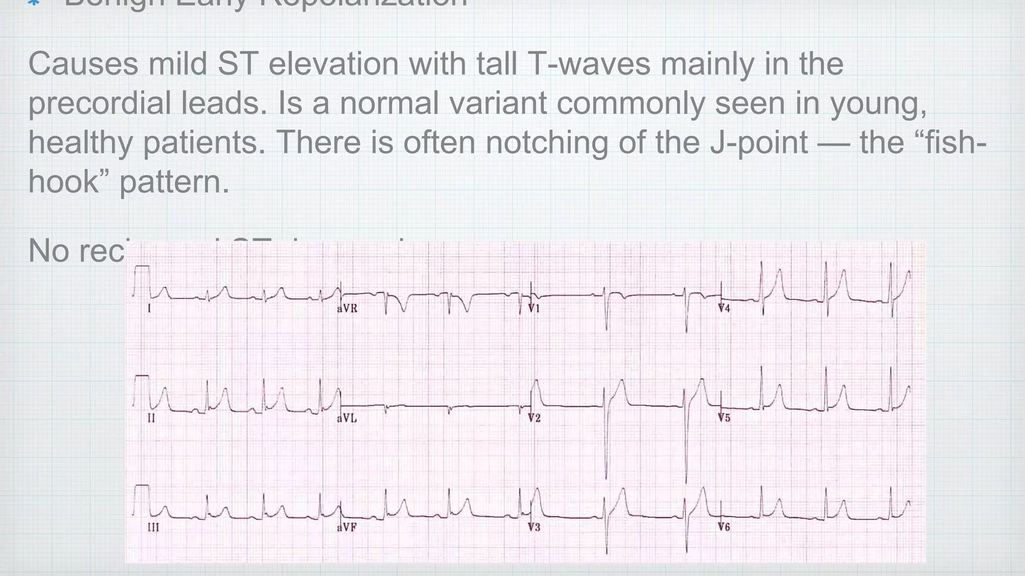 ECG Abnormalities in Pulmonary Medicine | PPTX
