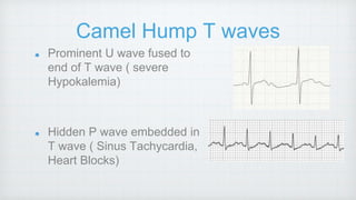 ECG Abnormalities in Pulmonary Medicine | PPTX