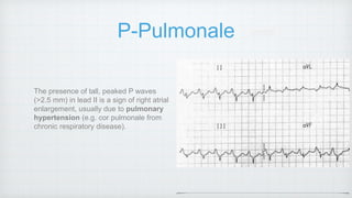 ECG Abnormalities in Pulmonary Medicine | PPTX