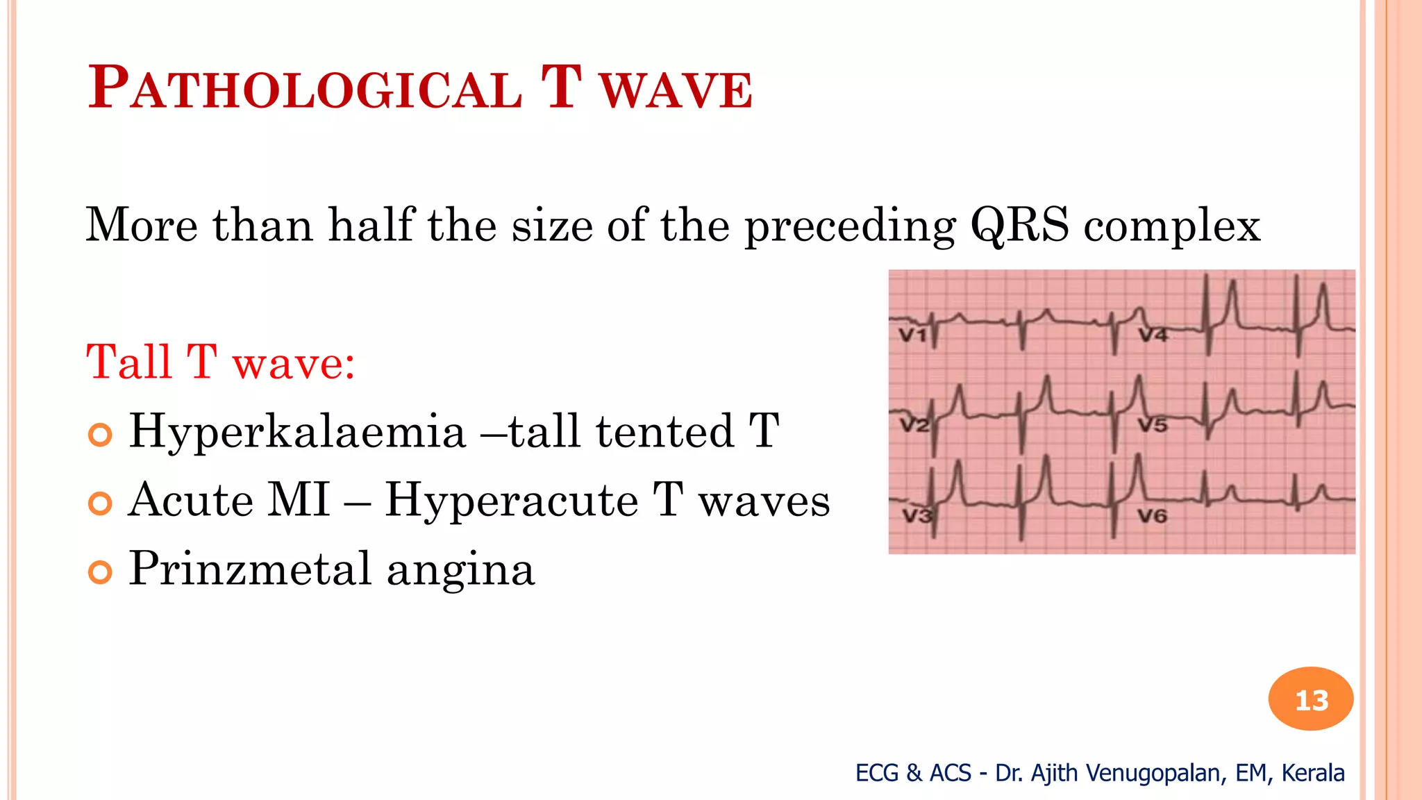 ECG & ACS - Dr. Ajith Venugopalan, EM, MOSC Medical College Hospital ...