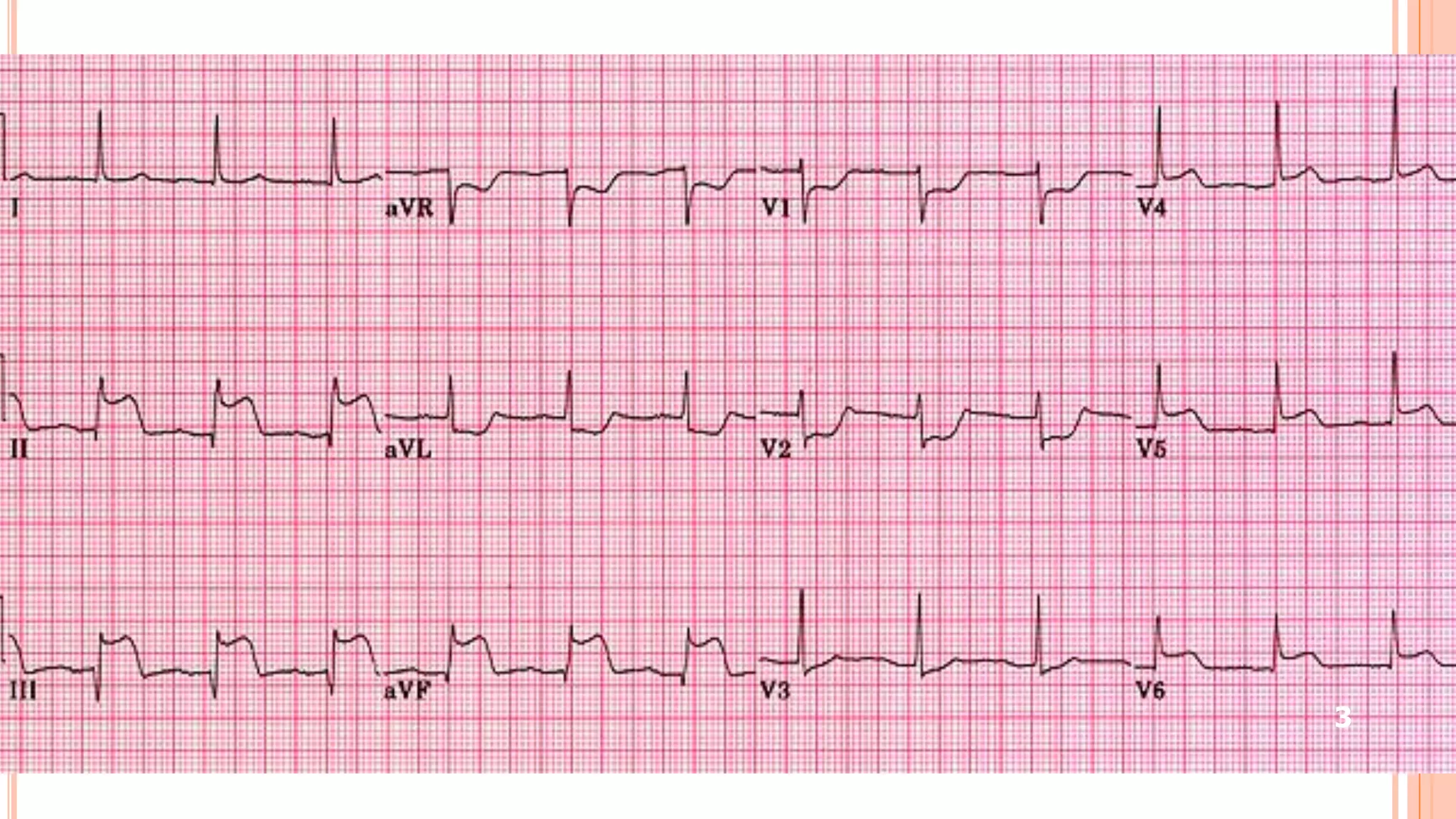 ECG & ACS - Dr. Ajith Venugopalan, EM, MOSC Medical College Hospital ...