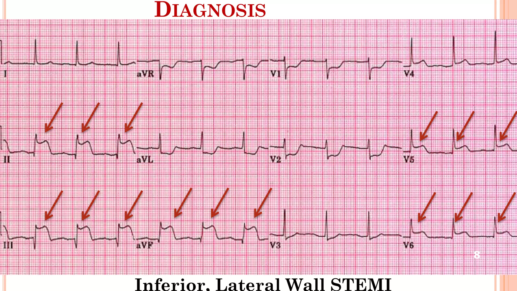 ECG & ACS - Dr. Ajith Venugopalan, EM, MOSC Medical College Hospital ...