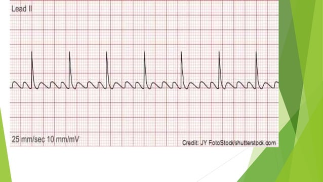 ECG analysis on normal sinus rhythm and atrial arrhythmias.pptx