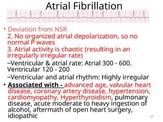 nursing cardiology ECG AND DYSRHYTHMIAS.ppt