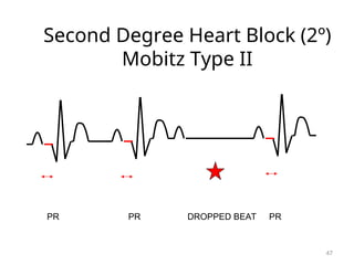 nursing cardiology ECG AND DYSRHYTHMIAS.ppt