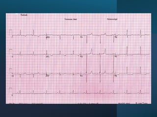ECG and electrolyte imbalance and interpretation | PPTX